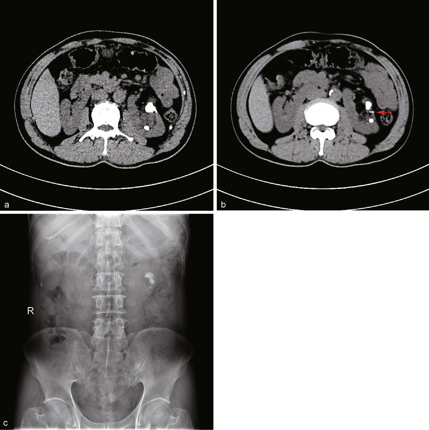 Hem-o-Lok clip migration into renal pelvis and stone formation as a long-term complication ...