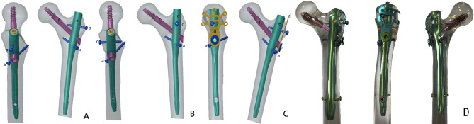The proximal femoral universal nail system (PFUN): a novel intramedullary nail for treating ...