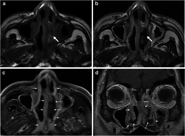 Differential diagnosis of sinonasal extranodal NK/T cell lymphoma and diffuse large B cell ...