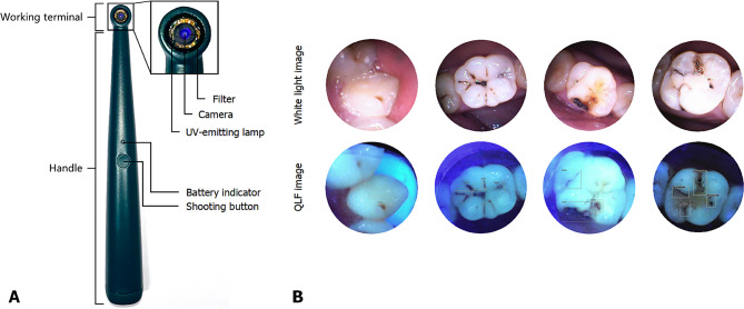 Caries lesions diagnosis with deep convolutional neural network in intraoral QLF images by ...