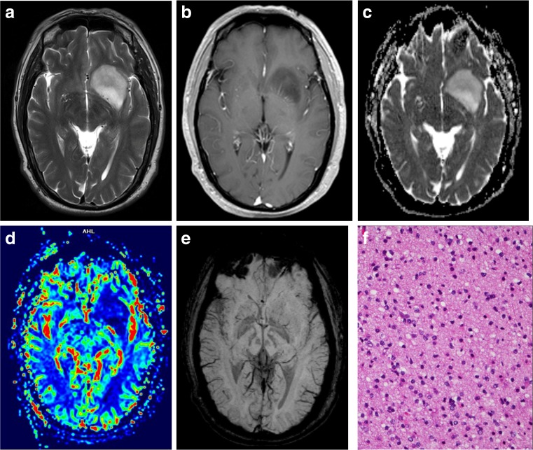IDH mutant and 1p/19q co-deleted oligodendrogliomas: tumor grade stratification using diffusion ...