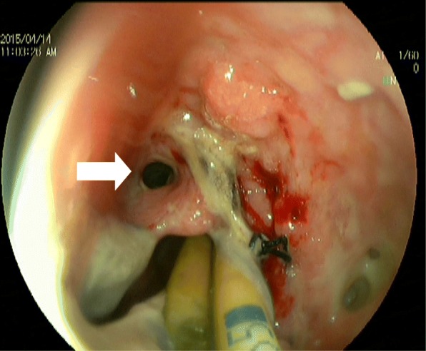 Endoscopic injection of human fibrin sealant in treatment of intrathoracic anastomotic leakage ...