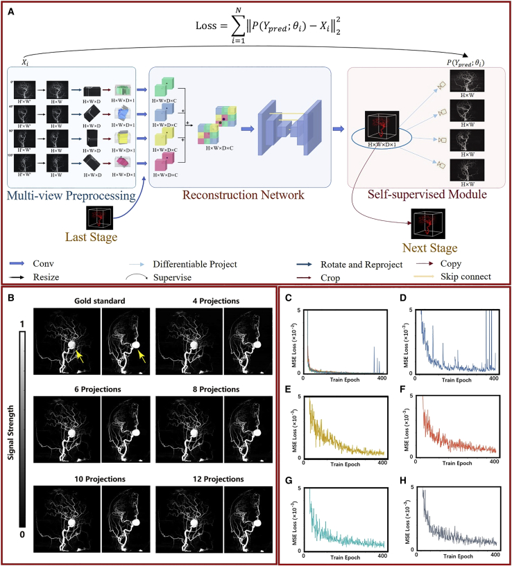 Self-supervised learning enables 3D digital subtraction angiography reconstruction from ultra ...