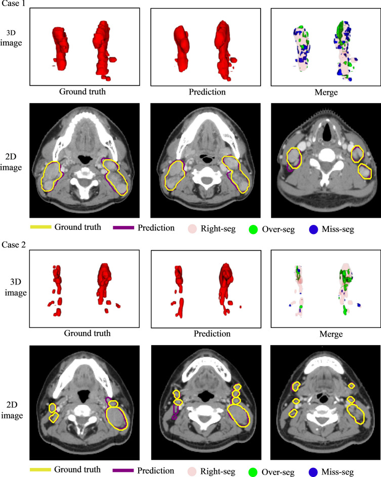 Automatic cervical lymph nodes detection and segmentation in heterogeneous computed tomography ...