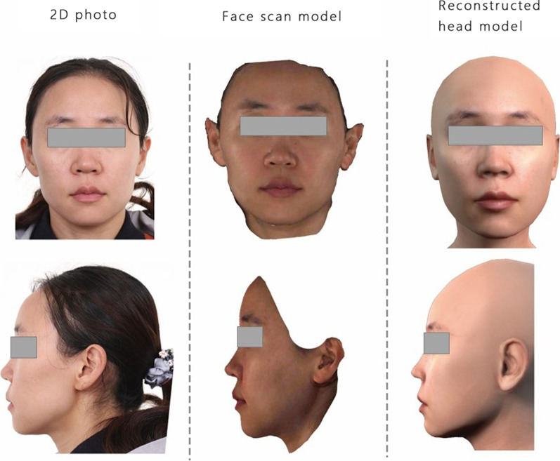 The accuracy of a three-dimensional face model reconstructing method ...
