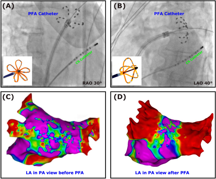 Next-generation atrial fibrillation ablation: clinical performance of pulsed-field ablation and ...