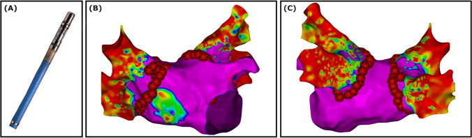 Next-generation atrial fibrillation ablation: clinical performance of pulsed-field ablation and ...