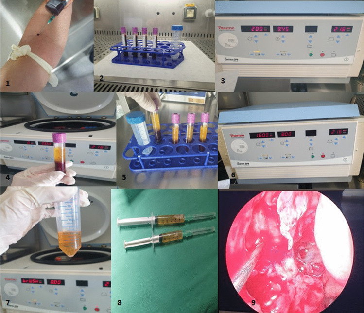 The impact of submucosal PRP injection on wound healing after endoscopic sinus surgery: a ...