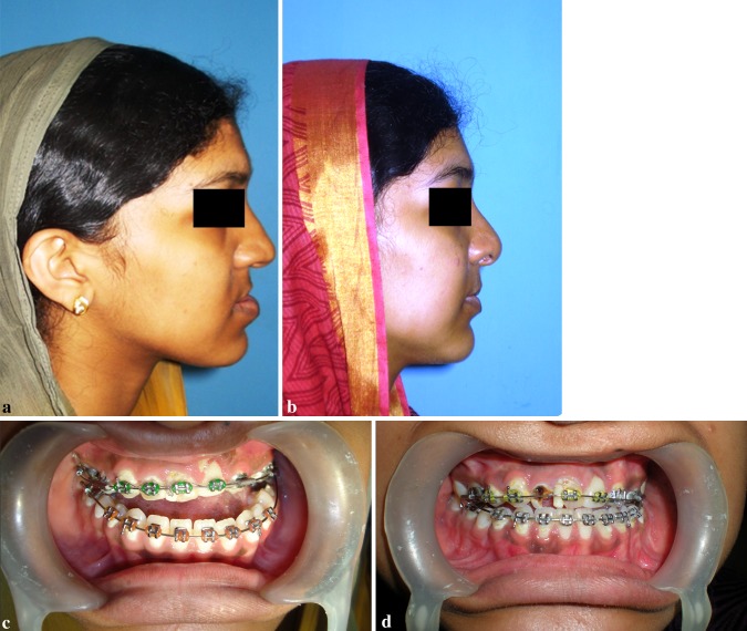 Management of Cleft Maxillary Hypoplasia with Anterior Maxillary Distraction: Our Experience - PMC