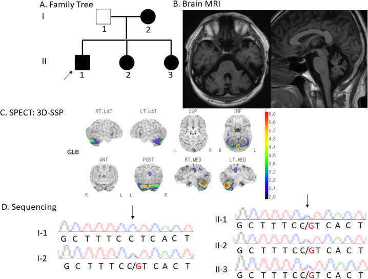 A heterozygous GRID2 mutation in autosomal dominant cerebellar ataxia - PMC