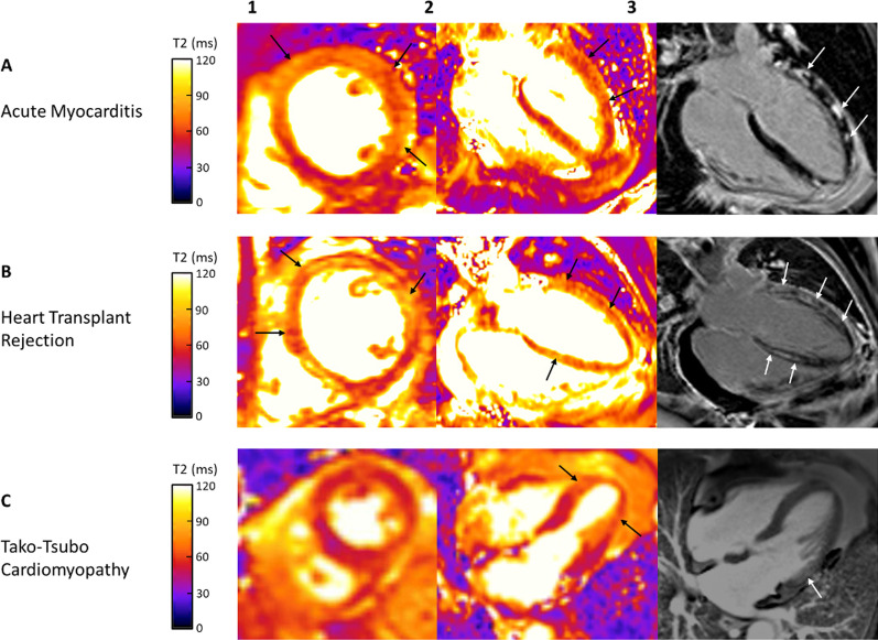 T2 mapping in myocardial disease: a comprehensive review - PMC