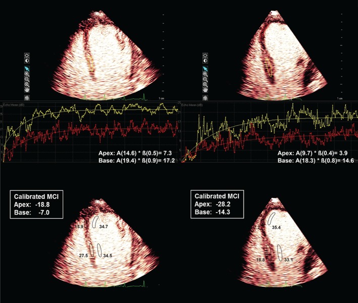 Quantitative segmental analysis of myocardial perfusion to differentiate stress cardiomyopathy ...