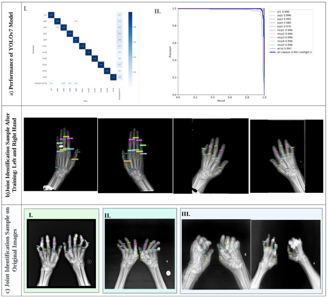 Multistage deep learning methods for automating radiographic sharp score prediction in ...