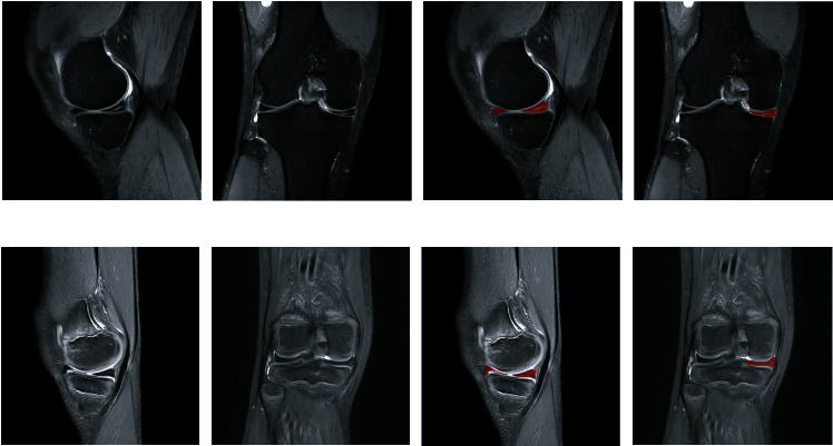 Feasibility of Constructing an Automatic Meniscus Injury Detection Model Based on Dual-Mode ...