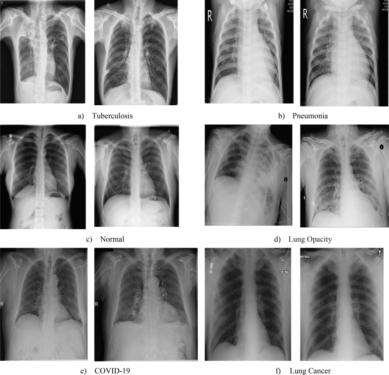A deep learning architecture for multi-class lung diseases classification using chest X-ray (CXR ...