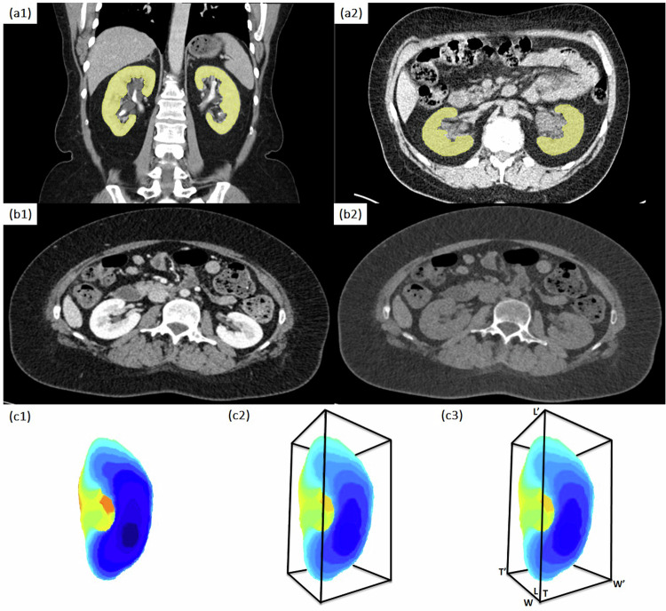 Segmentation-based quantitative measurements in renal CT imaging using deep learning - PMC