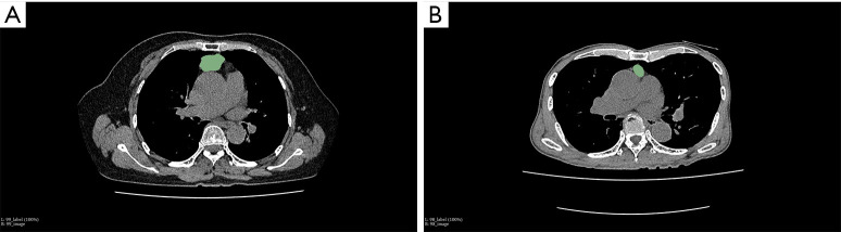 Construction of a multimodal artificial intelligence model for ...