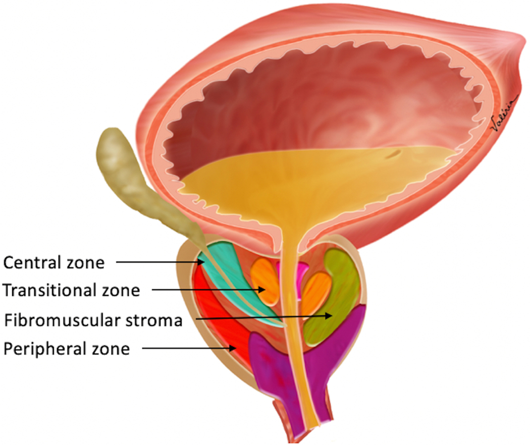 Prostatic Artery Embolization Indications Preparation Techniques