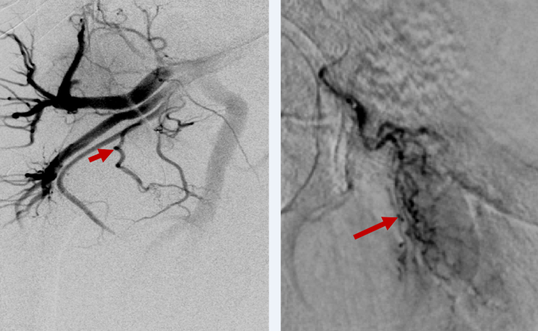 Prostatic Artery Embolization Indications Preparation Techniques