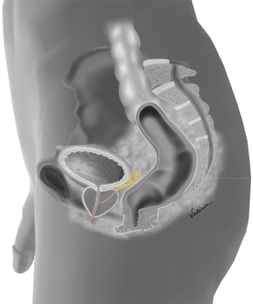 Prostatic Artery Embolization Indications Preparation Techniques