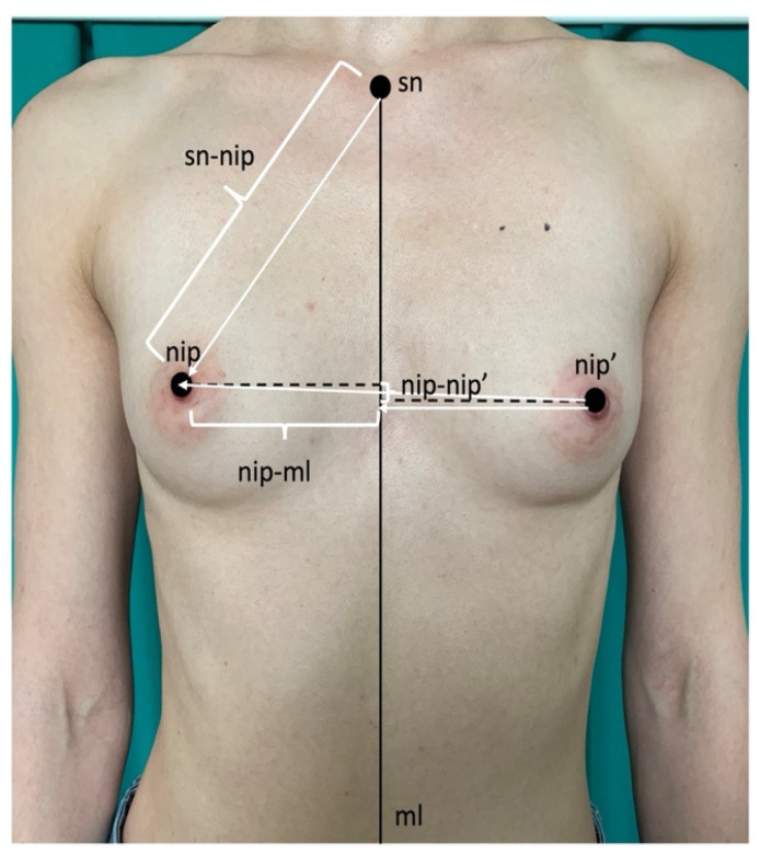 Breast Fluctuating Asymmetry In Women With Macromastia Gigantomastia Pmc