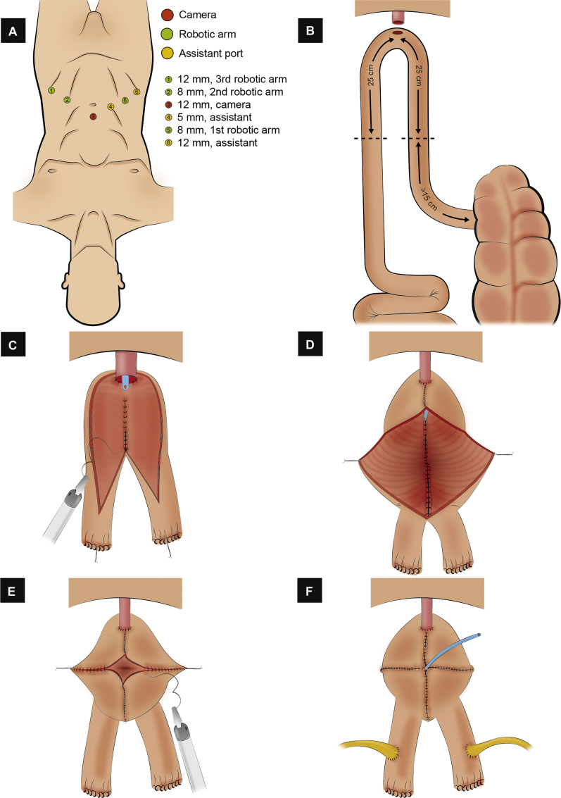 Totally intracorporeal robot-assisted urinary diversion for bladder cancer (part 2). Review and ...