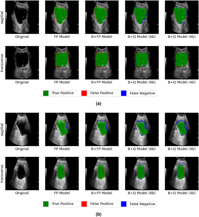 Memory-efficient low-compute segmentation algorithms for bladder-monitoring smart ultrasound ...