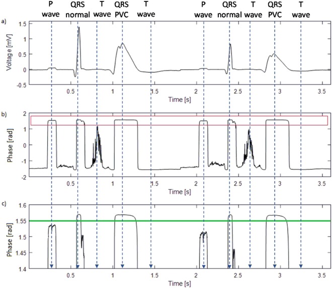 Advanced P Wave Detection in Ecg Signals During Pathology: Evaluation in Different Arrhythmia ...