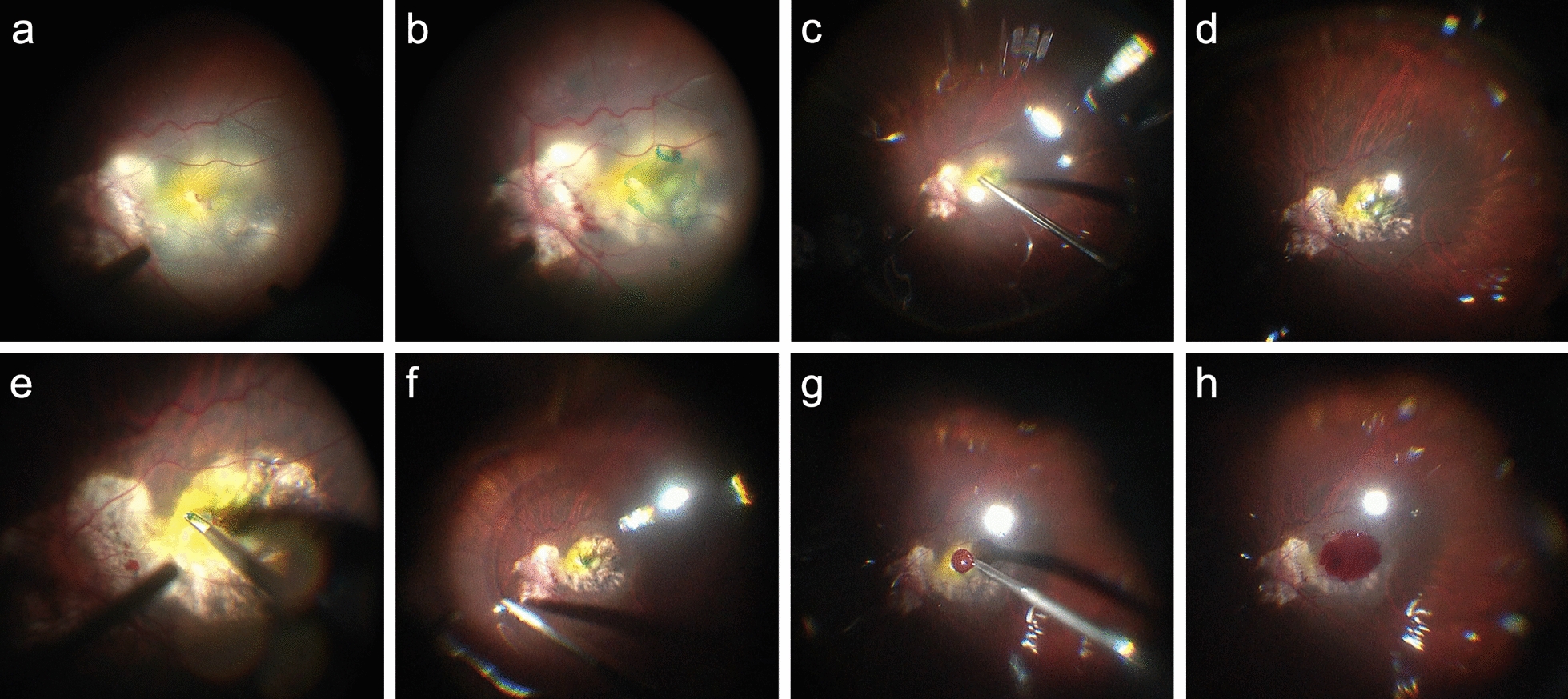 Comparison of the inverted internal limiting membrane flap technique without versus with an ...