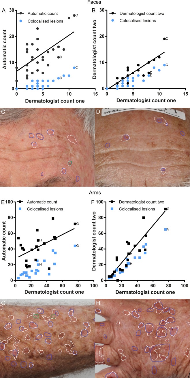 Automated Detection Of Actinic Keratoses In Clinical Photographs Pmc