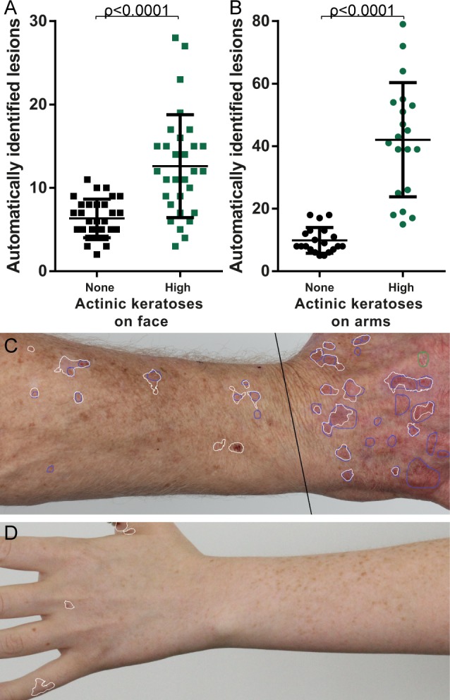Automated Detection Of Actinic Keratoses In Clinical Photographs Pmc