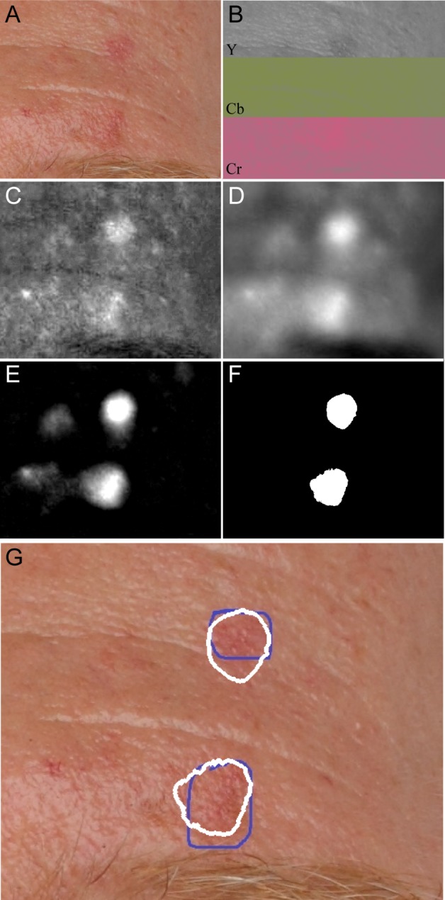 Automated Detection Of Actinic Keratoses In Clinical Photographs Pmc