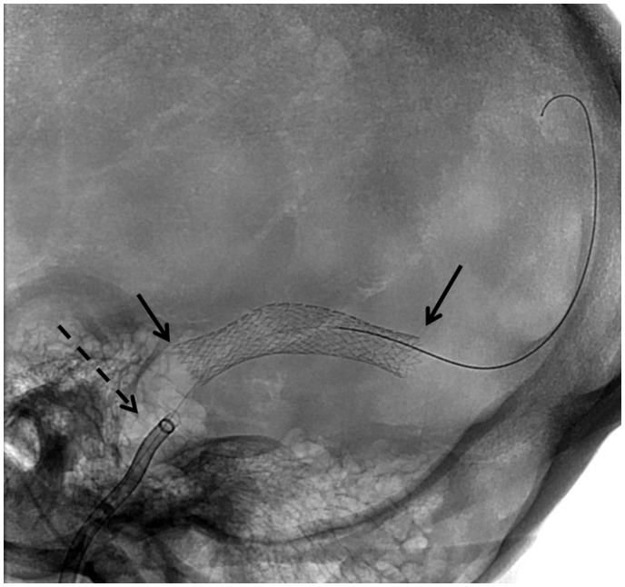 Dural venous sinus stenting for medically and surgically refractory ... Dural venous sinus stenting for medically and surgically refractory ...