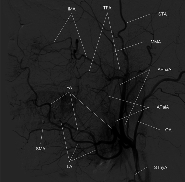 The effect of arterial spin labeling MR angiography (ASL-MRA) in visualizing the branches of ...
