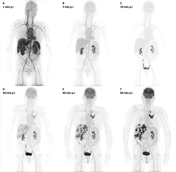 Impact of different parametric Patlak imaging approaches and comparison with a 2-tissue ...