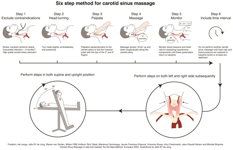 Carotid Sinus Massage In Clinical Practice The Six Step Method Pmc
