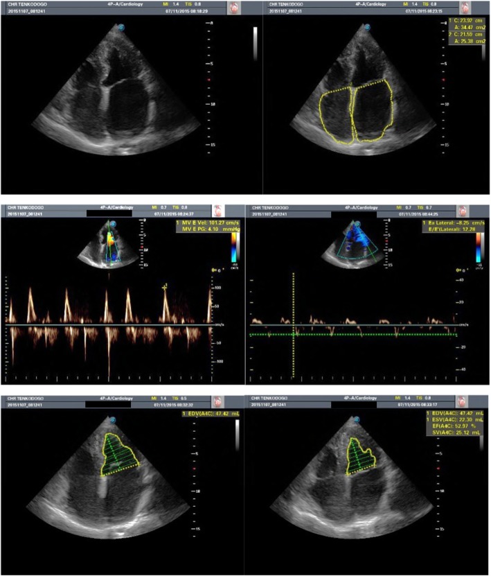 Epidemiology and long-term prognosis of atrial fibrillation in rural ...