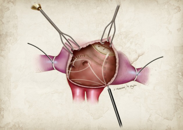 Concomitant Cox-Maze IV techniques during mitral valve surgery - PMC