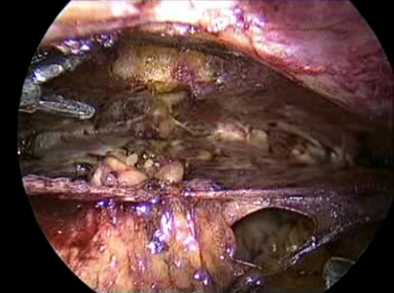 Laparoscopic Transabdominal Preperitoneal Repair of Ventral Hernia: A Step Towards Physiological ...