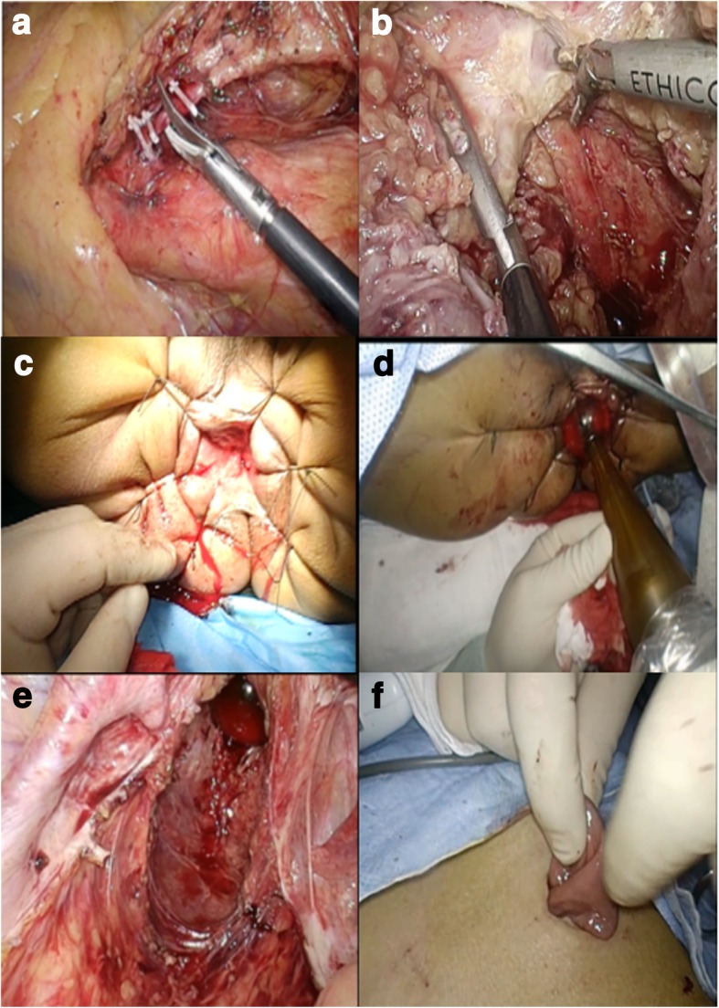 Laparoscopic intersphincteric resection with intraoperative radiotherapy using low-energy X-rays ...