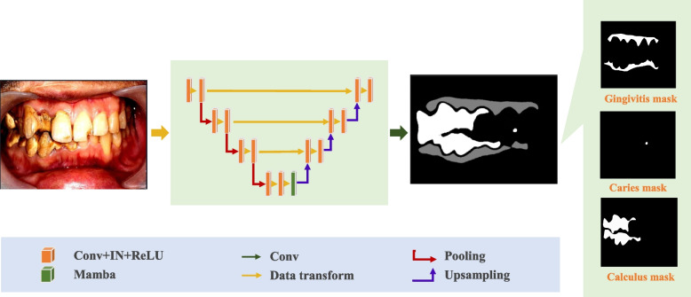 Oral screening of dental calculus, gingivitis and dental caries through segmentation on ...