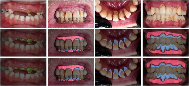 Oral screening of dental calculus, gingivitis and dental caries through segmentation on ...
