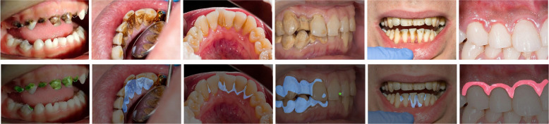 Oral screening of dental calculus, gingivitis and dental caries through segmentation on ...