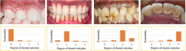 Oral screening of dental calculus, gingivitis and dental caries through segmentation on ...