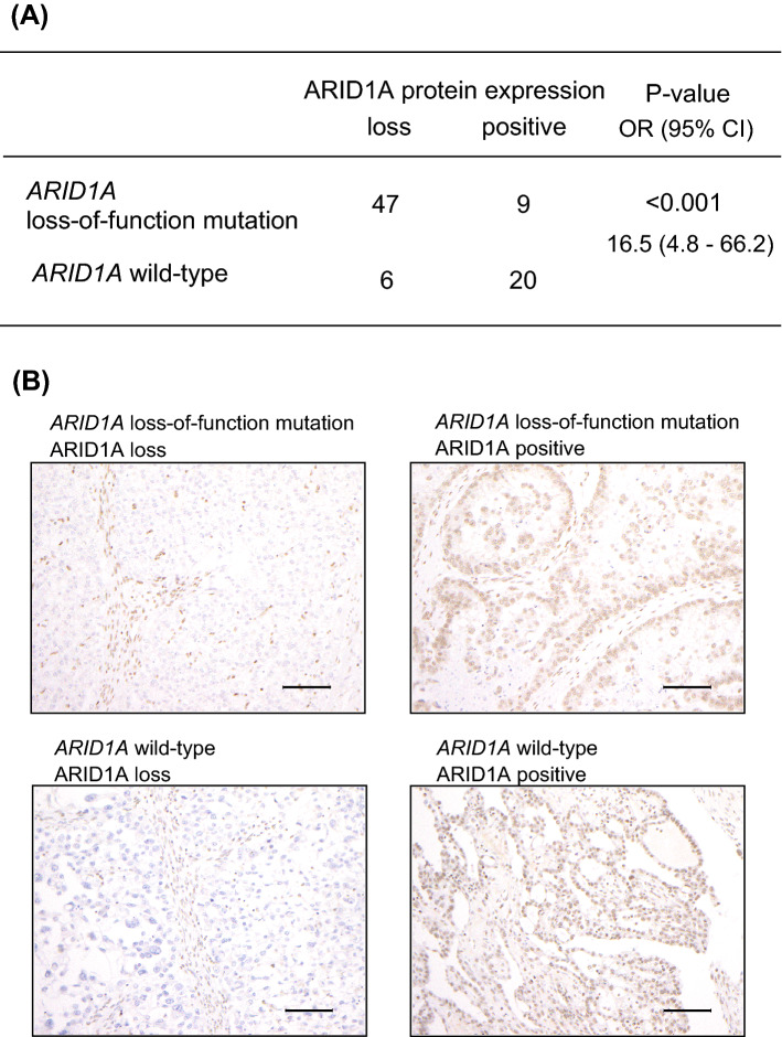 ARID1A protein expression is retained in ovarian endometriosis with ARID1A loss-of-function ...