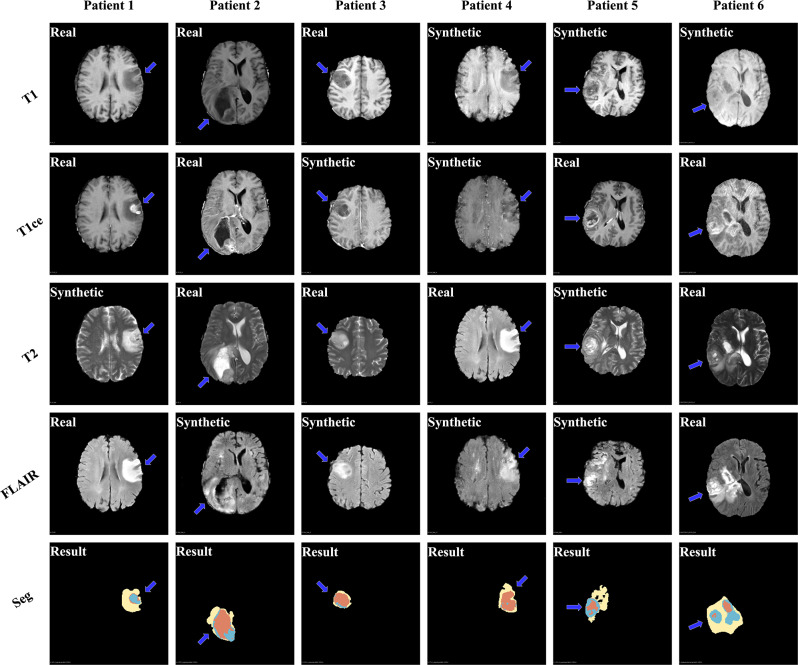 Deep learning-driven modality imputation and subregion segmentation to ...