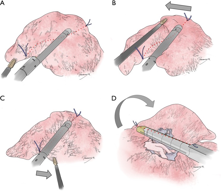 The AMAGAMI technique: an easy technique to achieve precise stapling in thoracoscopic ...
