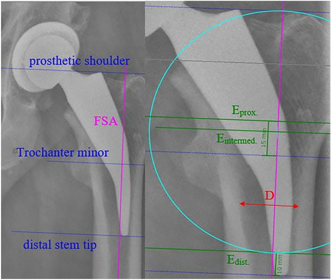 Retrospective clinical and X-ray-based outcome analysis of a short-stem hip arthroplasty taking ...