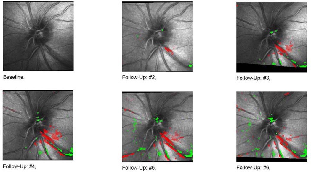 Imaging of the Optic Nerve and Retinal Nerve Fiber Layer: an Essential ...