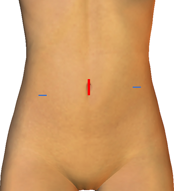 Successful laparoscopic transabdominal preperitoneal repair of recurrent inguinal hernia of the ...